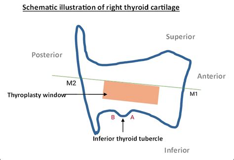 Type 1 Thyroplasty Using A Novel And Inflatable Implant From Aprevent® Vois Ent And Audiology News