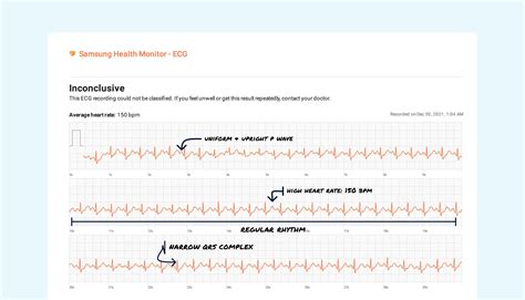 Reentry Supraventricular Tachycardia Vs Sinus Tachycardia