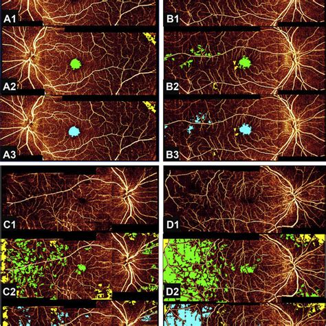 Pdf Quantification Of Nonperfusion Area In Montaged Wide Field