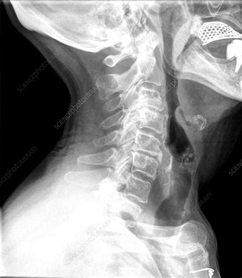 Cervical Spine X Ray Stock Image C056 4214 Science Photo Library