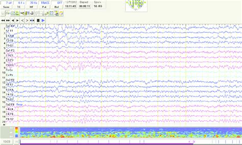 Left Temporal Sharp Waves Download Scientific Diagram