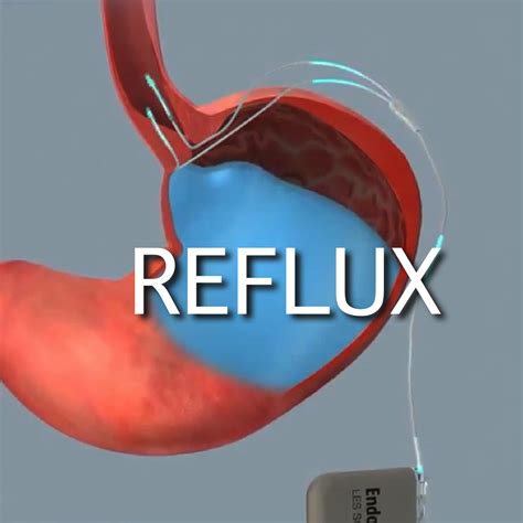 Reflux Transoral Incisionless Fundoplication For Treatment Of Gastroesophageal Reflux Nicole