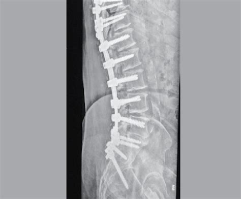 Postoperative View Of Long Instrumentation With Iliac Fixation Lateral