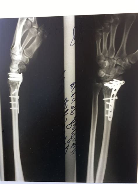 Перелом ДЕМ проміневої кістки зі зміщенням Клініка доктора Лінько