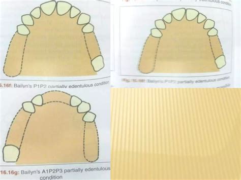 Introduction And Classification Of Removable Partial Denture Pptx