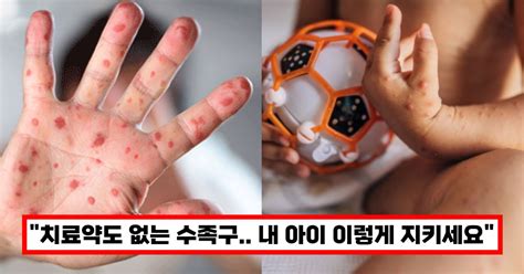 전국을 덮친 수족구 주의보 또 다시 발령입니다 치료약도 없는 수족구로부터 내 아이 이렇게 지키세요 뉴스를 싣고