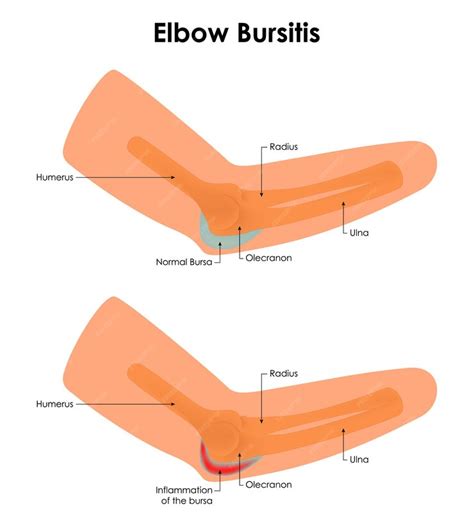 Premium Vector Elbow Bursitis Radius Humerus Normal Bursa Olecranon