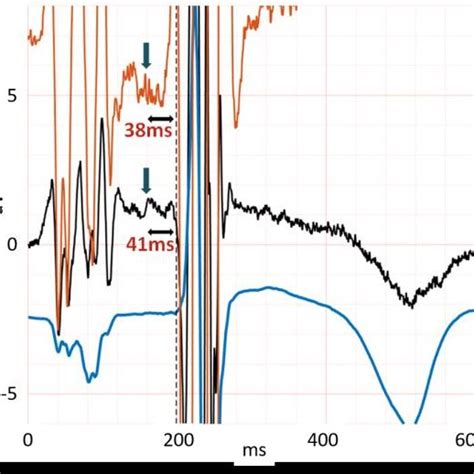 This Figure Shows Patient 25 Filtered Bipolar Signal 3 Orange Signal Download Scientific