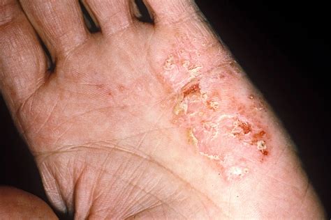 Eczema Types Symptoms Causes Diagnosis And Treatment