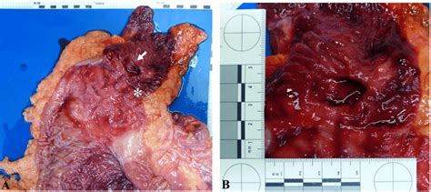 Autopsy Findings Revealing A Mucosal Defect In The Duodenum ← Right
