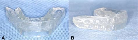 Postoperative Occlusal Splint A Frontal View B Lateral View Download Scientific Diagram