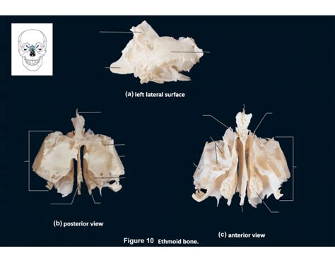 Ethmoid Bone Left Lateral Posterior Anterior Quiz