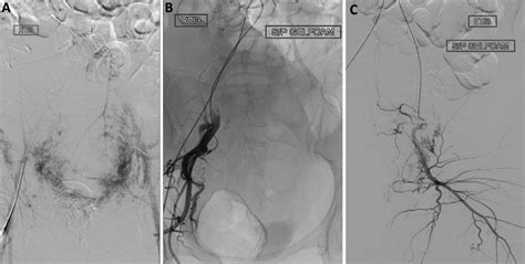 Digital Subtraction Angiogram DSA Images Of The Pelvis During Download Scientific Diagram