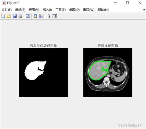 【第 26 章 基于最小误差法和区域生长的医学影响分割系统 Matlab深度学习实战gui项目】基于matlab Gui的医用系统开发