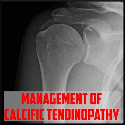 Shoulder Calcification
