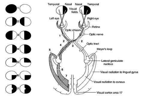 Quadrantanopia Eye Unilateral Optic Nerve Hypoplasia In A Patient Desiring