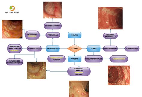 Algoritmos Diagnósticos De La Colitis Gastro Mérida