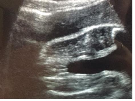 For Those Told Wrong Sex At Ultrasound BabyCentre