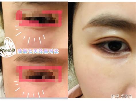 关于我对眼下细纹做出的诸多努力分享 知乎