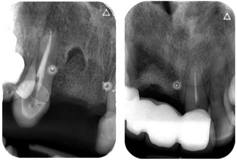Maxillary Bone Reconstruction In The Anterior Area With Cerabone® And Jason® Membrane Dr P Y