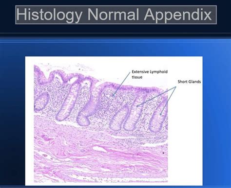 Pathology Of Acute Appendicitis Its Etiology Morphology Gross