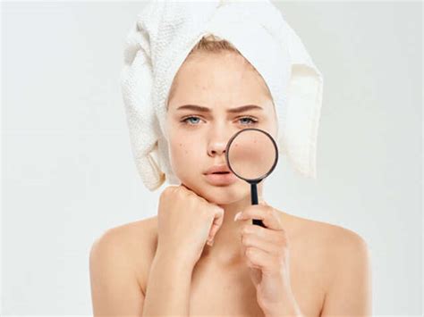 How To Remove Spots From Your Face Naturally In 2 Days Femina In