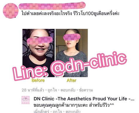 🛎 รับจำนวนจำกัด 5 ท่านเท่านั้น โปรรีวิว 💉 Botox 50 Unit 1 599 Botox 100 Unit 2 199 Filler 1 Cc