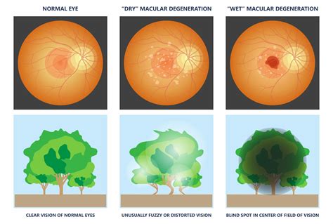 Macular Degeneration Test Grid At Jean Nelson Blog