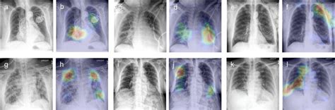 Representative Class Activation Maps Cams With Incorrect Lesion