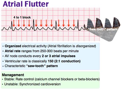 Atrial Flutter Life In The Fast Lane Ecg Library