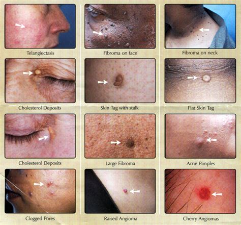 Flat Pimples On Face