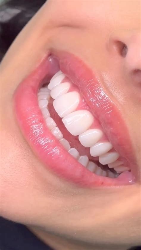 ВИНИР • ИМПЛАНТ• Veneer• Implant Veneers Dental Clinic • Instagram Photos And Videos