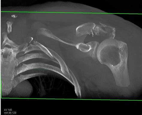 Scapula Fracture Ct Scan At David Rogge Blog