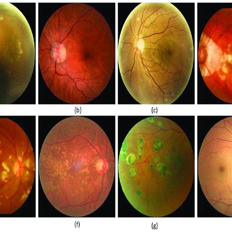 glaucoma images a macular epiretinal membrane b normal fundus