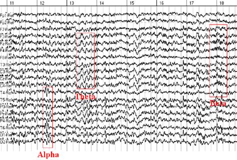Brainwaves And Eeg Example 121 Neurofeedback Services