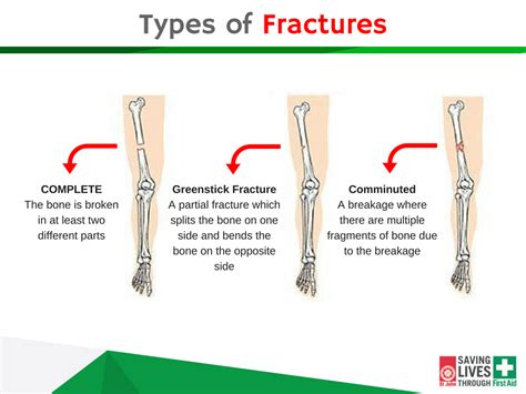 Open Vs Closed Fracture Meryassets