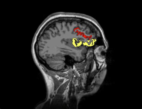 Pragmedic Limited On Linkedin Delineating Epileptogenic Networks Using Brain Imaging Data And…