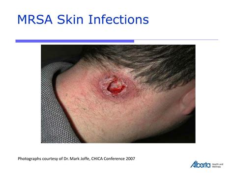 Ppt Provincial Mrsa Infection Prevention And Control Ipc Guidelines And Standards 2008