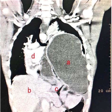 Ct Scan Revealing Herniation Of Abdominal Viscera Into The Left Pleura Download Scientific
