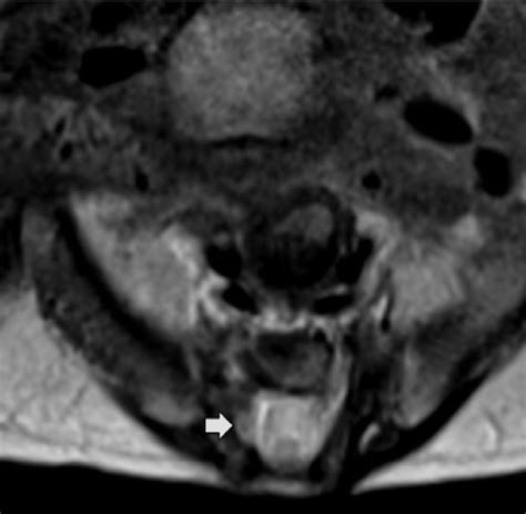 Segmental Spinal Dysgenesis Ochsner Journal
