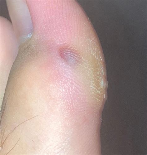 Bloedblaar Of Iets Anders Medische Forum Dokternl