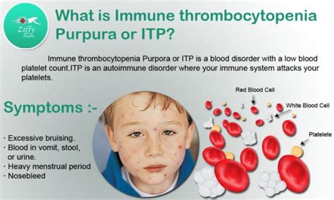 Immune Thrombocytopenia Itp Some Causes And Symptoms