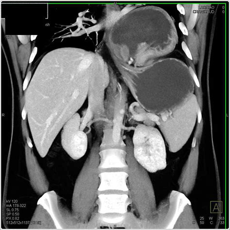 Large Hiatal Hernia With Gastric Volvulus Stomach Radiology Case