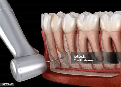 치아 방광 절제술 수술 골막염 후 회복 치과용 3d 일러스트레이션 건강관리와 의술에 대한 스톡 사진 및 기타 이미지 건강관리와 의술 경련 꼭대기 Istock