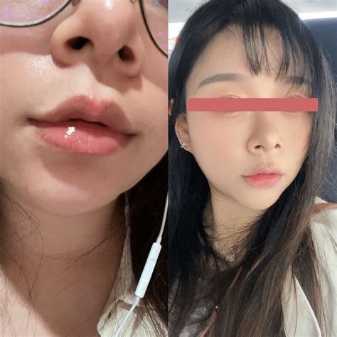 分享 玻尿酸豐唇 不對稱厚唇變身m型花瓣唇 醫美板 Dcard