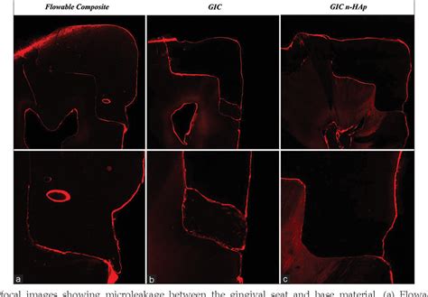 Figure 1 From Deep Margin Elevation In Class Ii Cavities A Comparative Evaluation Of