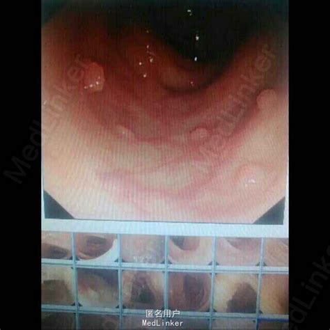 胃结肠多发息肉 密集恐惧症者慎点 医联