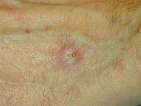 Gallery Signs Of Skin Cancer Globalnews Ca