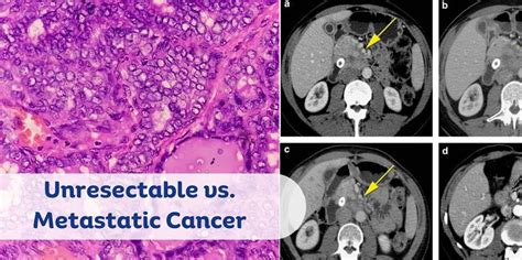Unresectable Vs Metastatic Cancer Whats The Difference And Why Does It Matter Pi Health