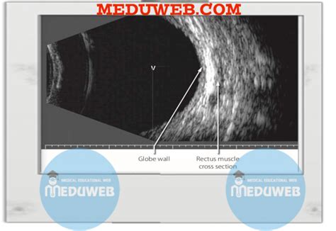 Normal And Abnormal B Scan Meduweb